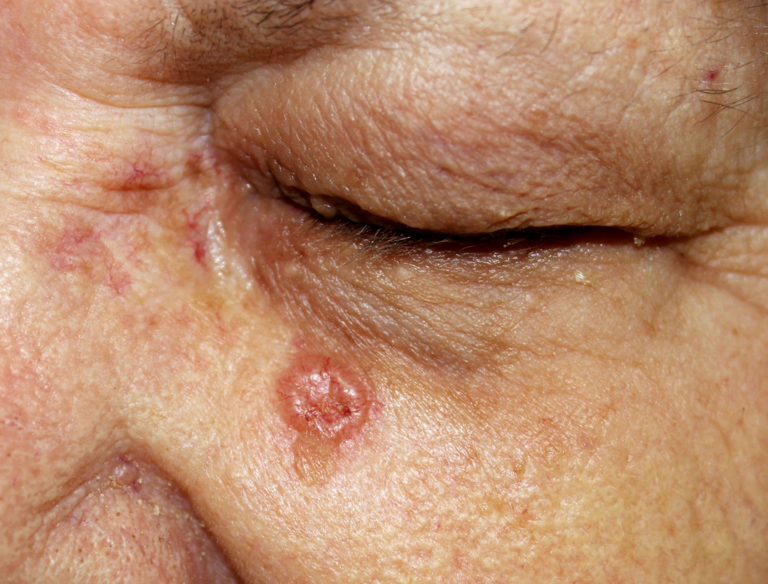 Weisser Hautkrebs Auge