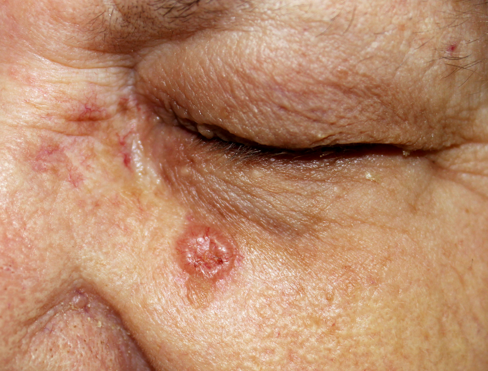 Basaliom am Auge | Weißen Hautkrebs am Augenlid behandeln